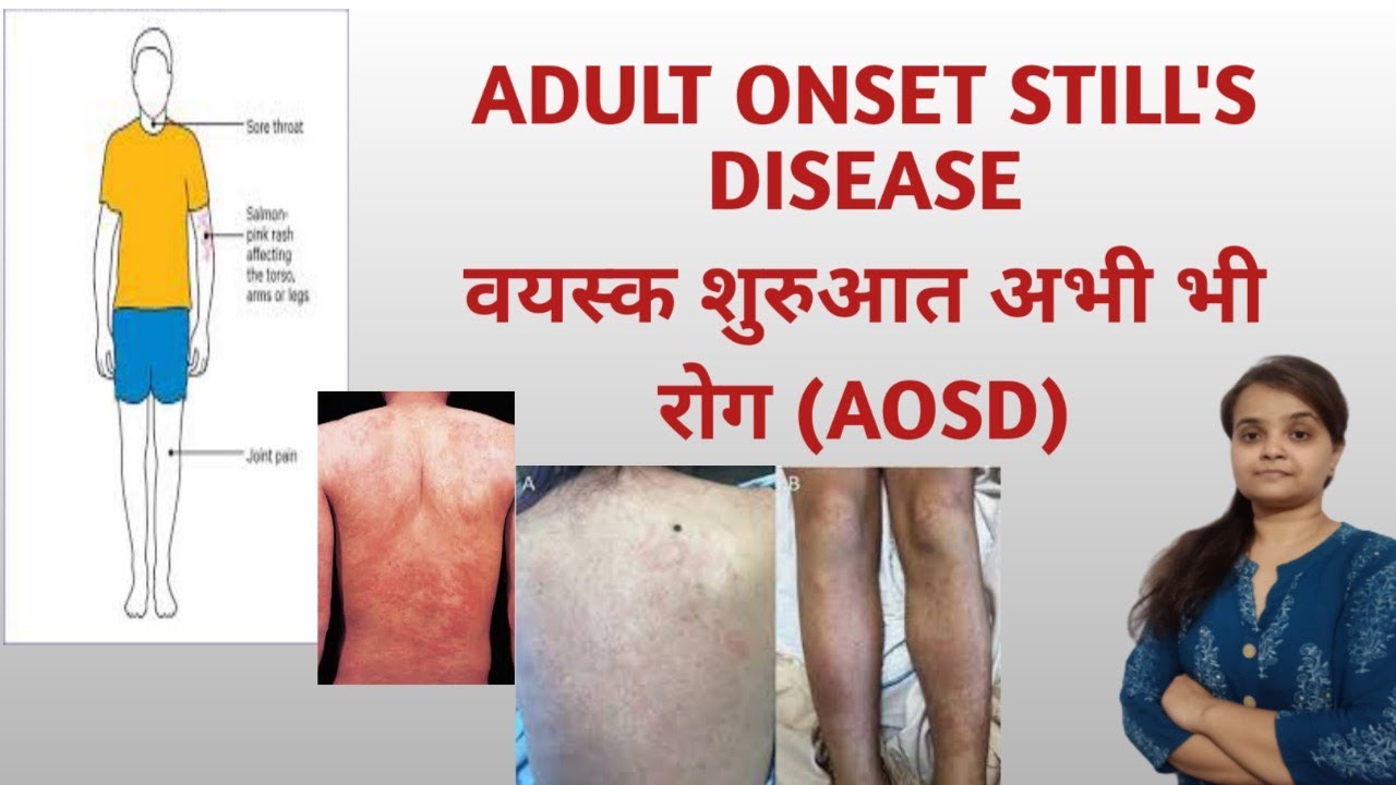 ADULT ONSET STILL'S DISEASE (वयस्क शुरुआत अभी भी रोग AOSD) - YouTube