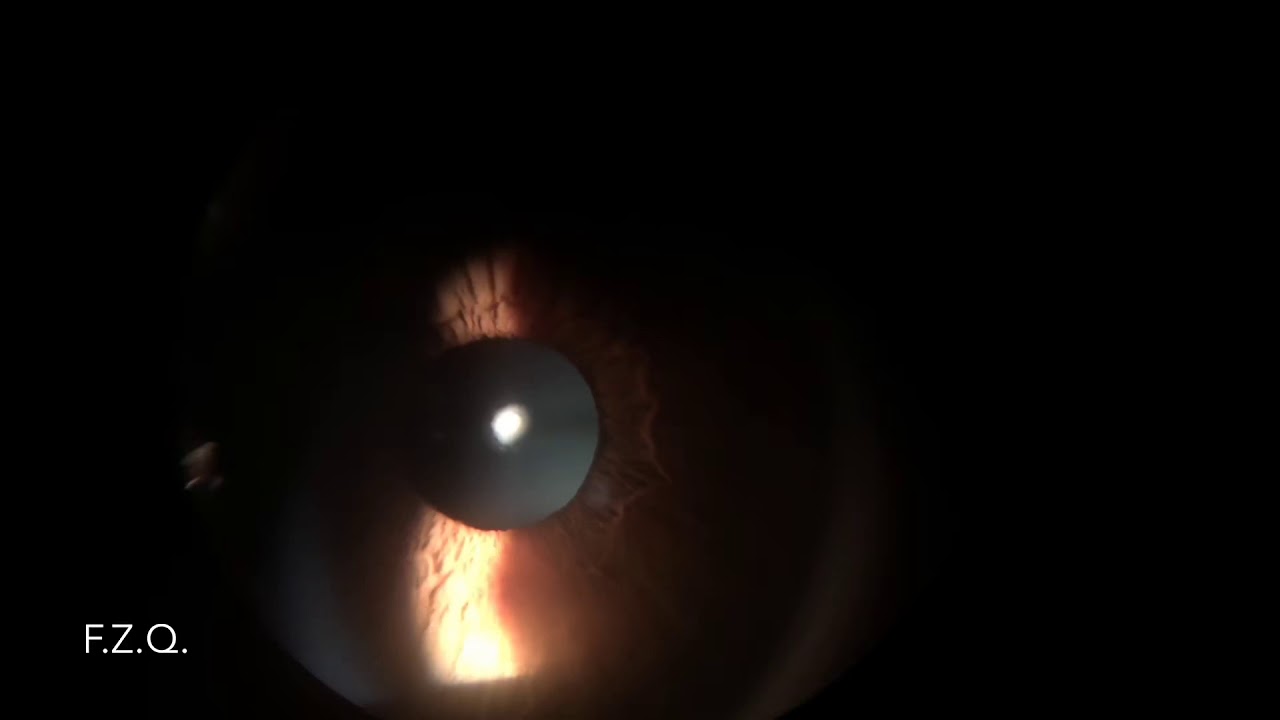 Catarata polar anterior y posterior. - YouTube