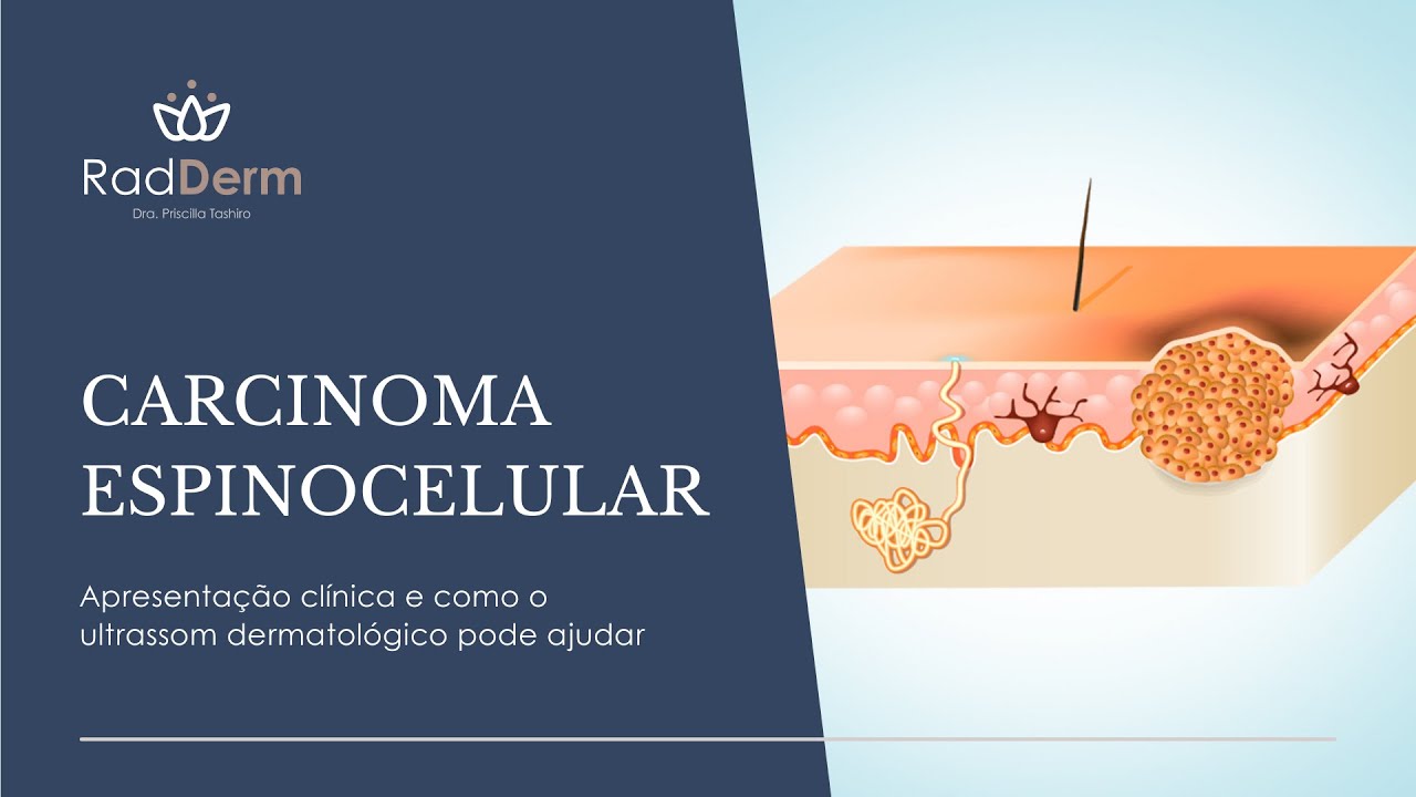 Carcinoma Espinocelular (CEC) | Apresentação clínica e como oultrassom ...