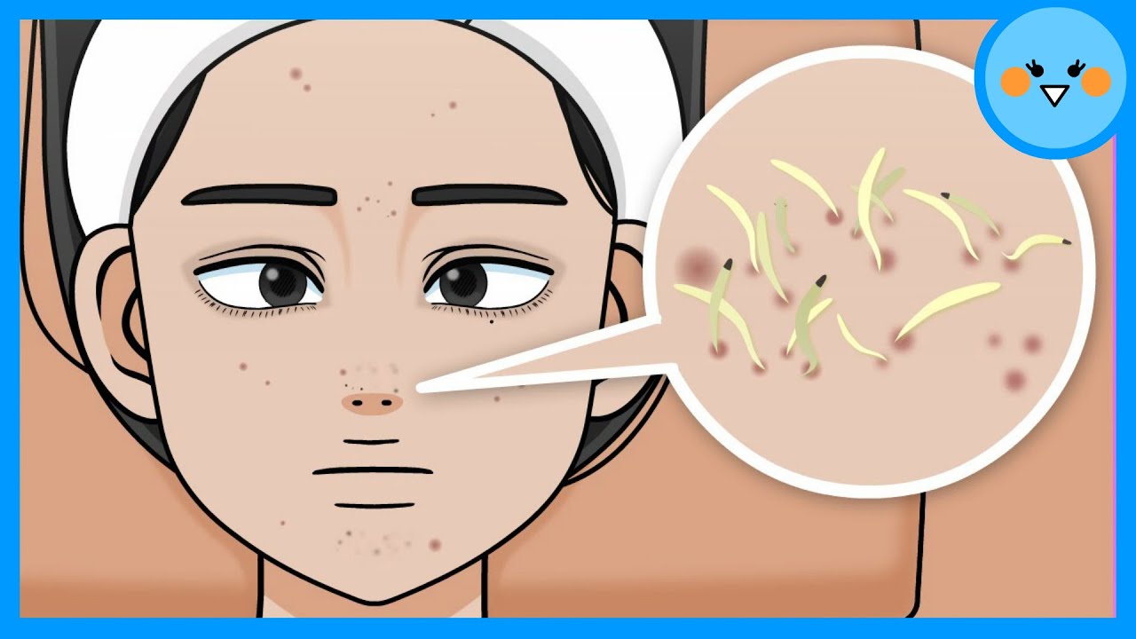 🤩여드름,피지 박멸하는애니메이션🤩Removing sebum animation pimple pop｜ASMR - YouTube