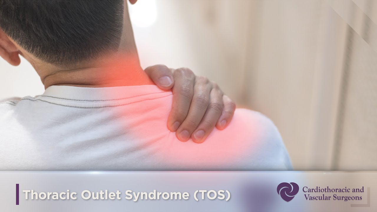 Thoracic Outlet Syndrome (TOS) | CTVS Texas | Vascular Surgery - YouTube