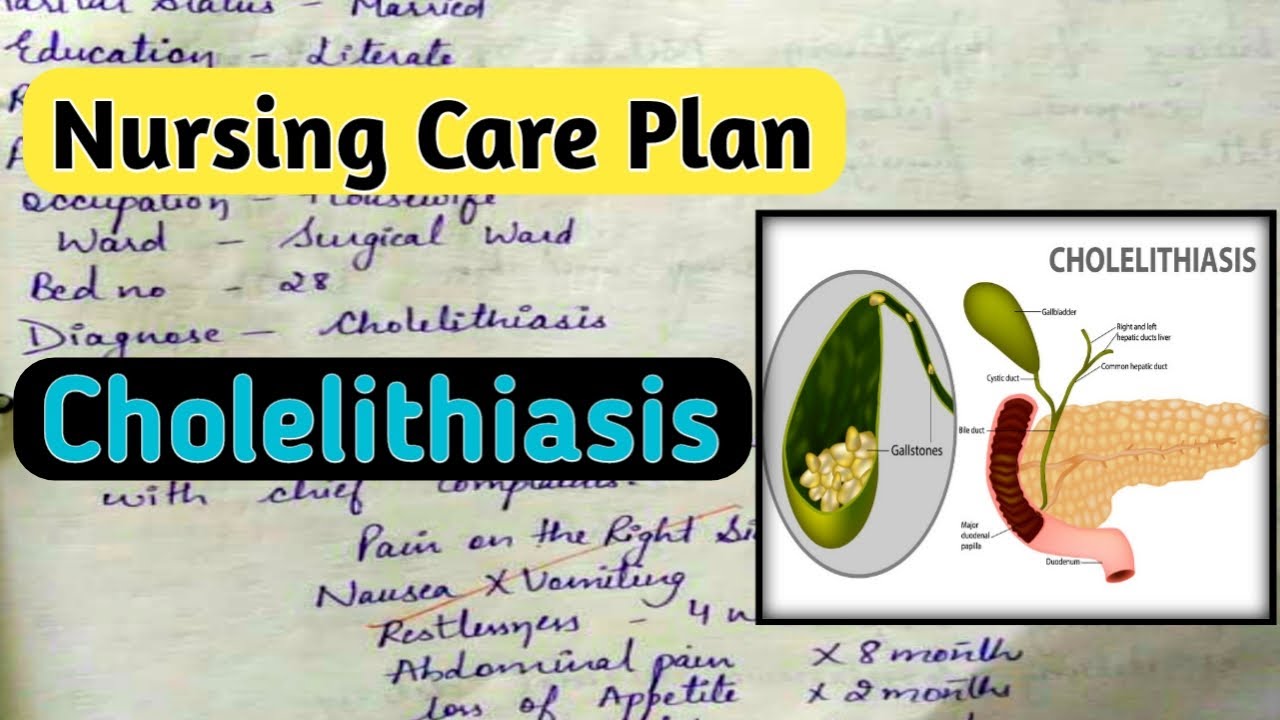 Nursing Care Plan on Cholelithiasis #nursingcriteria - YouTube