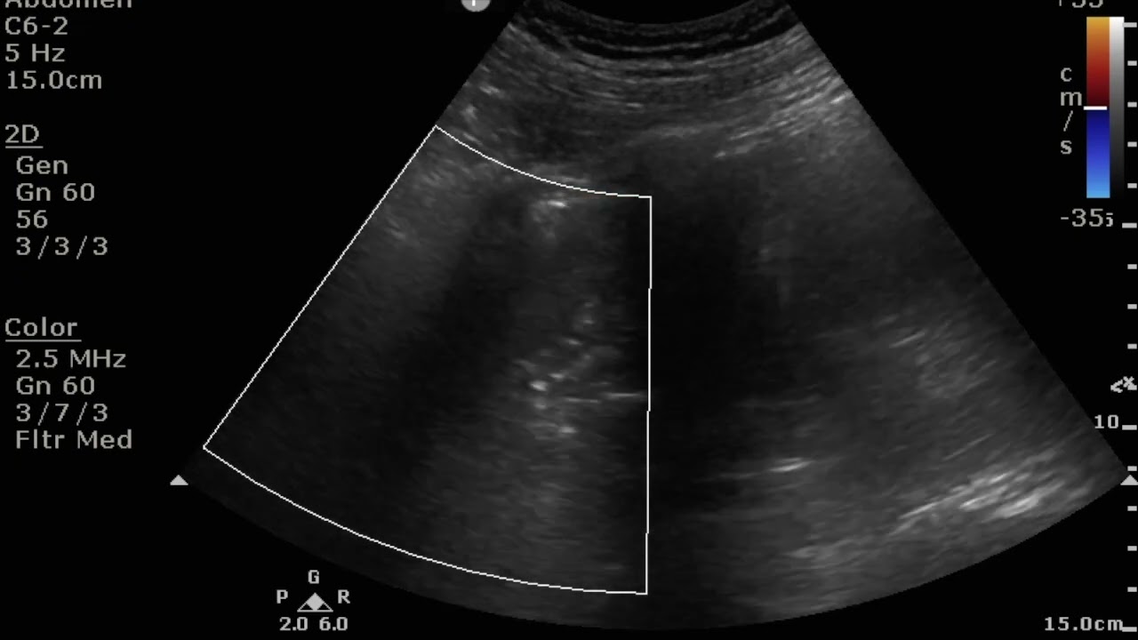Chapter 11 - Colour flow Doppler of the lung - YouTube