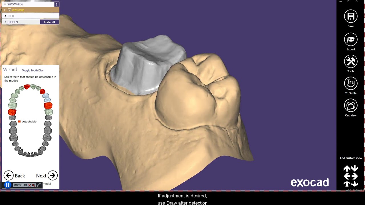 Create a model in Exocad for ND5100 - YouTube