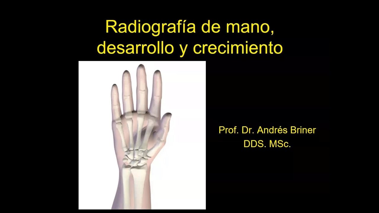 Radiografía de mano y edad ósea - YouTube