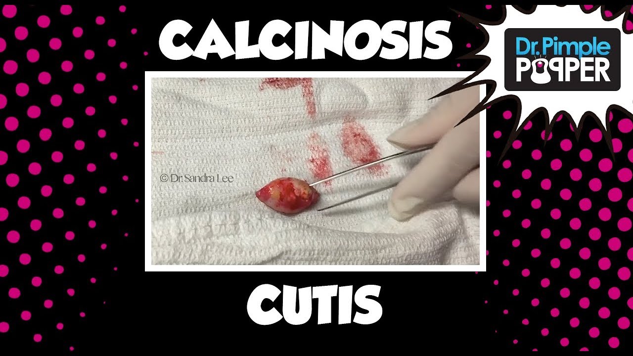 Two "Cysts" Calcinosis Cutis - YouTube