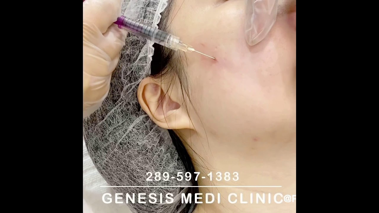 Dermal Filler Injection at Genesis Medi Clinic - YouTube