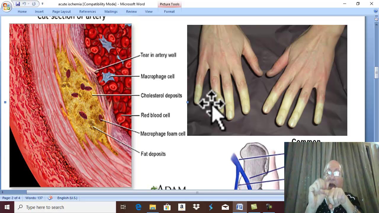 Peripheral Arterial diseases 2 ( Acute ischemia , aetiology ) , by Dr ...