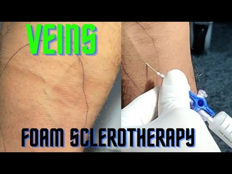 Foam Sclerotherapy Treatment| Treatment of varicose veins in Ranchi ...