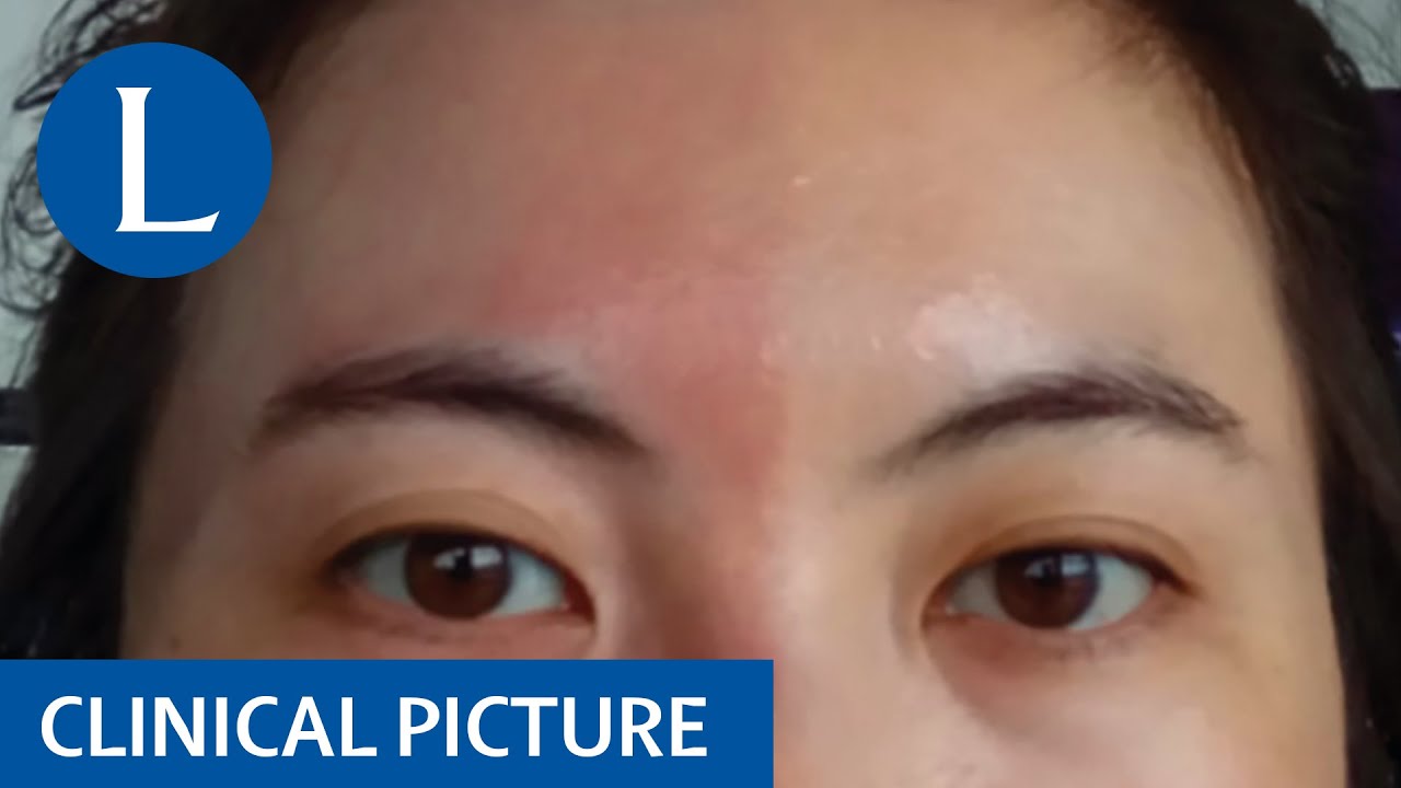 Facial flushing in Harlequin syndrome - YouTube