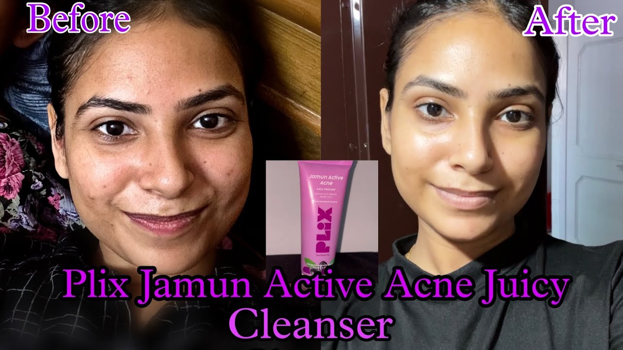 How I Reduced My Pigmentation With PLIX Jamun Active Acne Face Cleanser ...