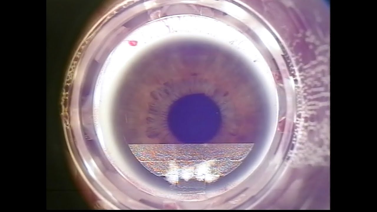 Femto - LASIK procedure for the correction of myopia with the use of ...