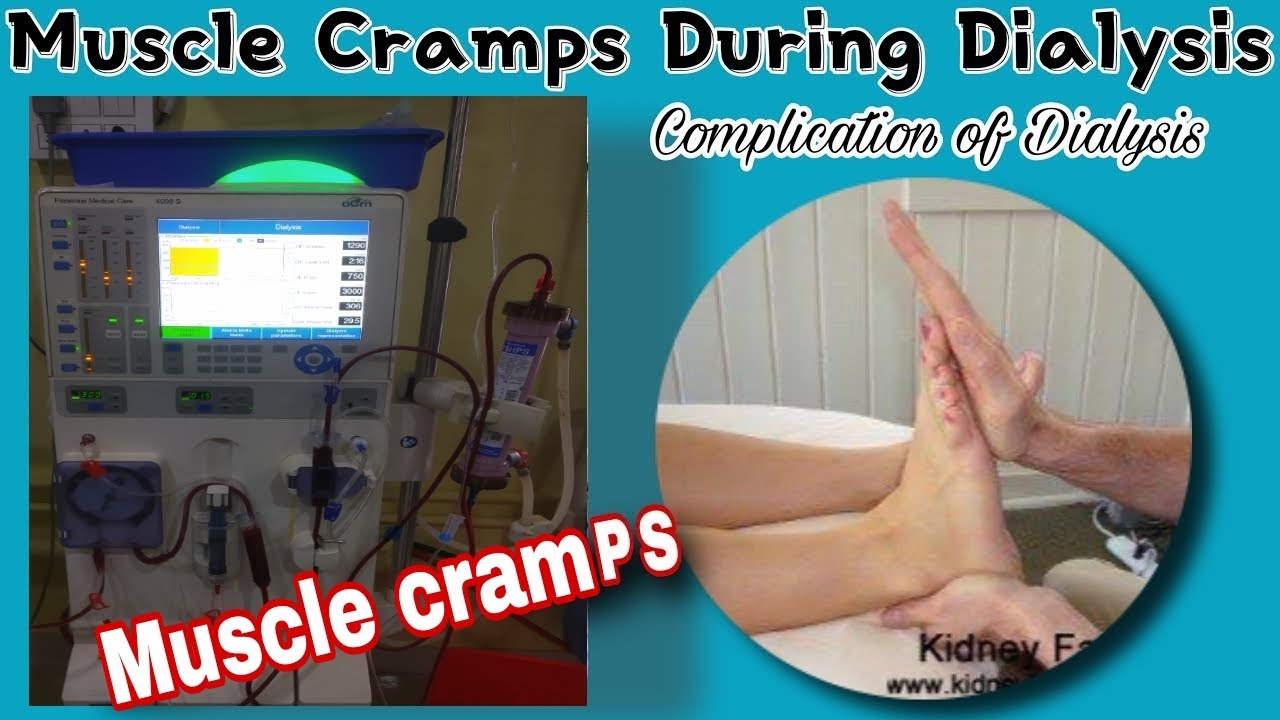 Hemodialysis Complication | Muscle Cramps During Dialysis मांसपेशियों में ऐंठन क्या हैं? - YouTube