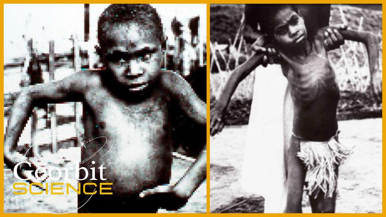 The Disturbing History Of Kuru, The Fatal Brain Disease Caused By Cannibalism - YouTube
