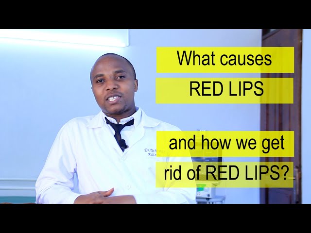 Cherry Red Lips Causes And Treatment