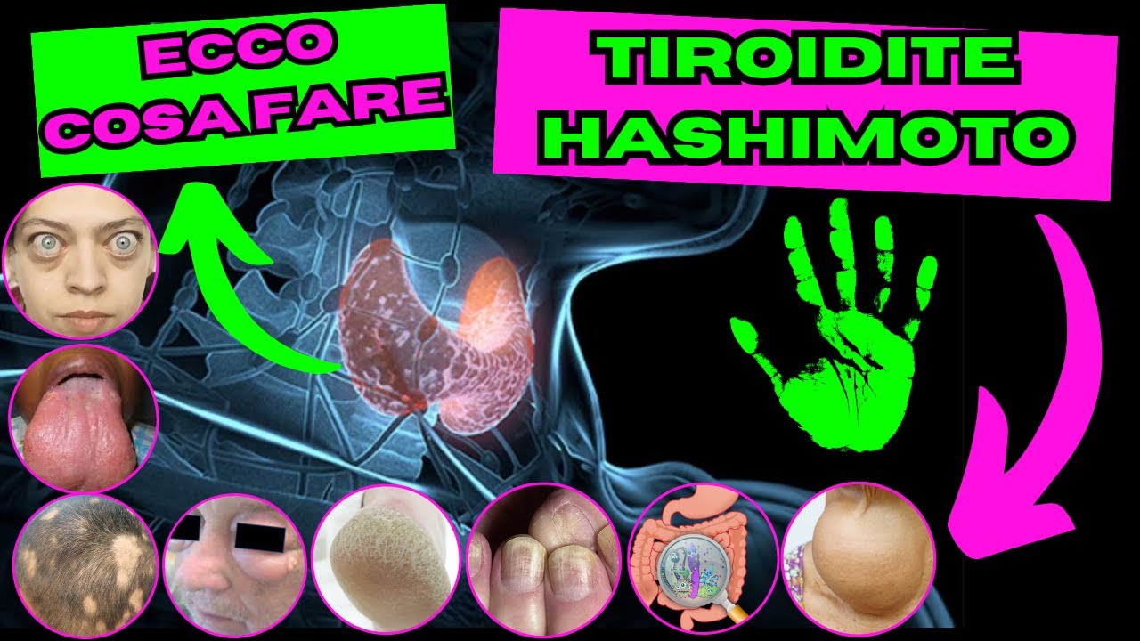🟢TIROIDITE DI HASHIMOTO ️TUTTO CIO’ CHE DEVI SAPERE! - YouTube