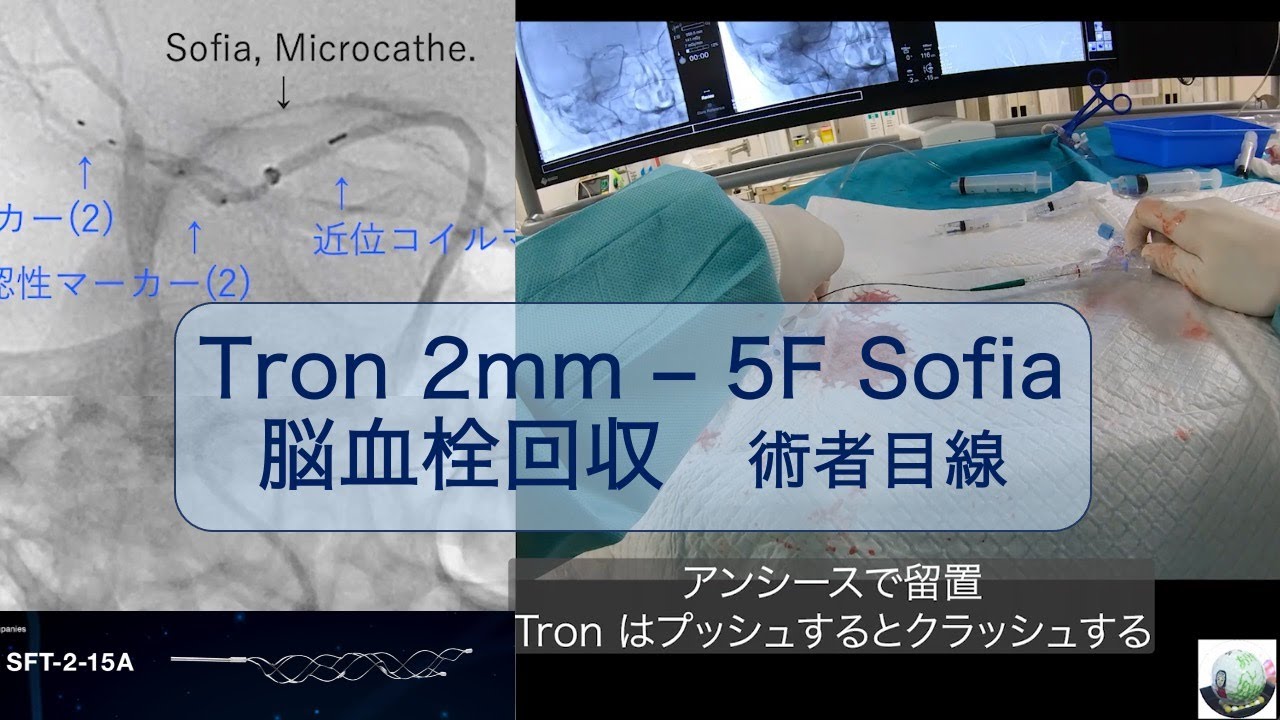 Tron 2mm Stent-retriever 脳血栓回収 5F Sofia併用 術者目線 - YouTube