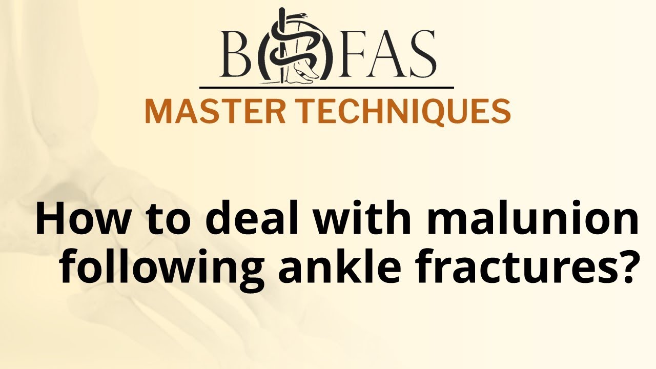 How to deal with malunion following ankle fractures - BOFAS Master ...