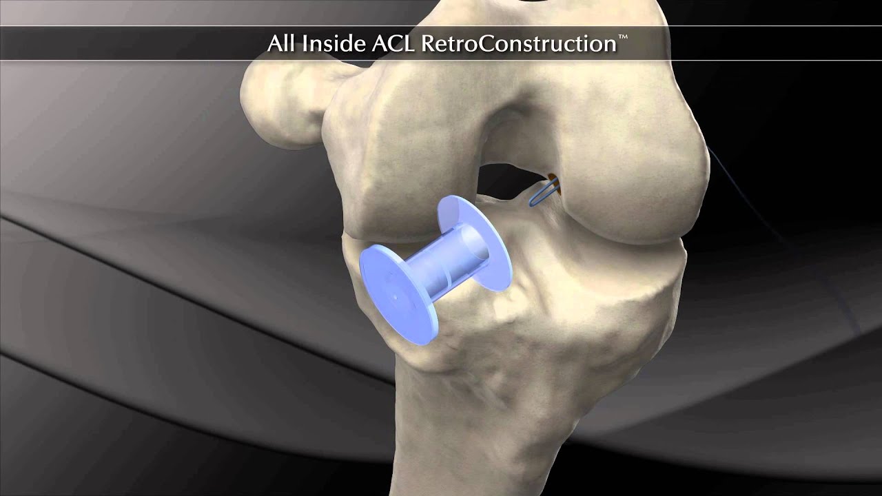 All Inside ACL Retroconstruction HD1080 - YouTube