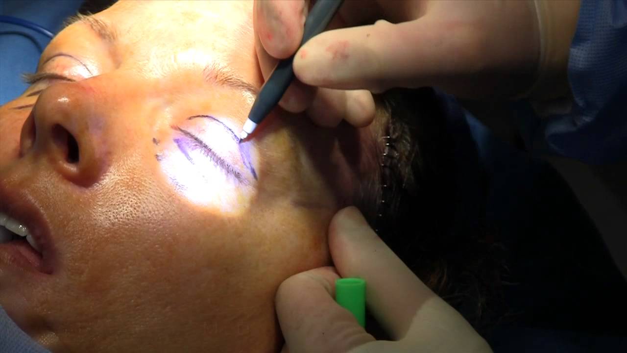 Temporal Brow Lift and Upper Eyelid Blepharoplasty - YouTube