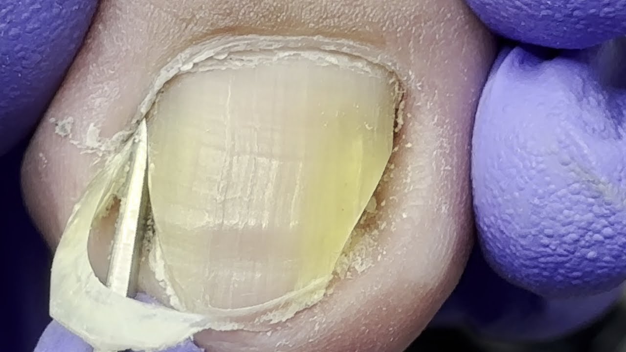 The nails are split, and large pieces of nails are cut off, which is ...