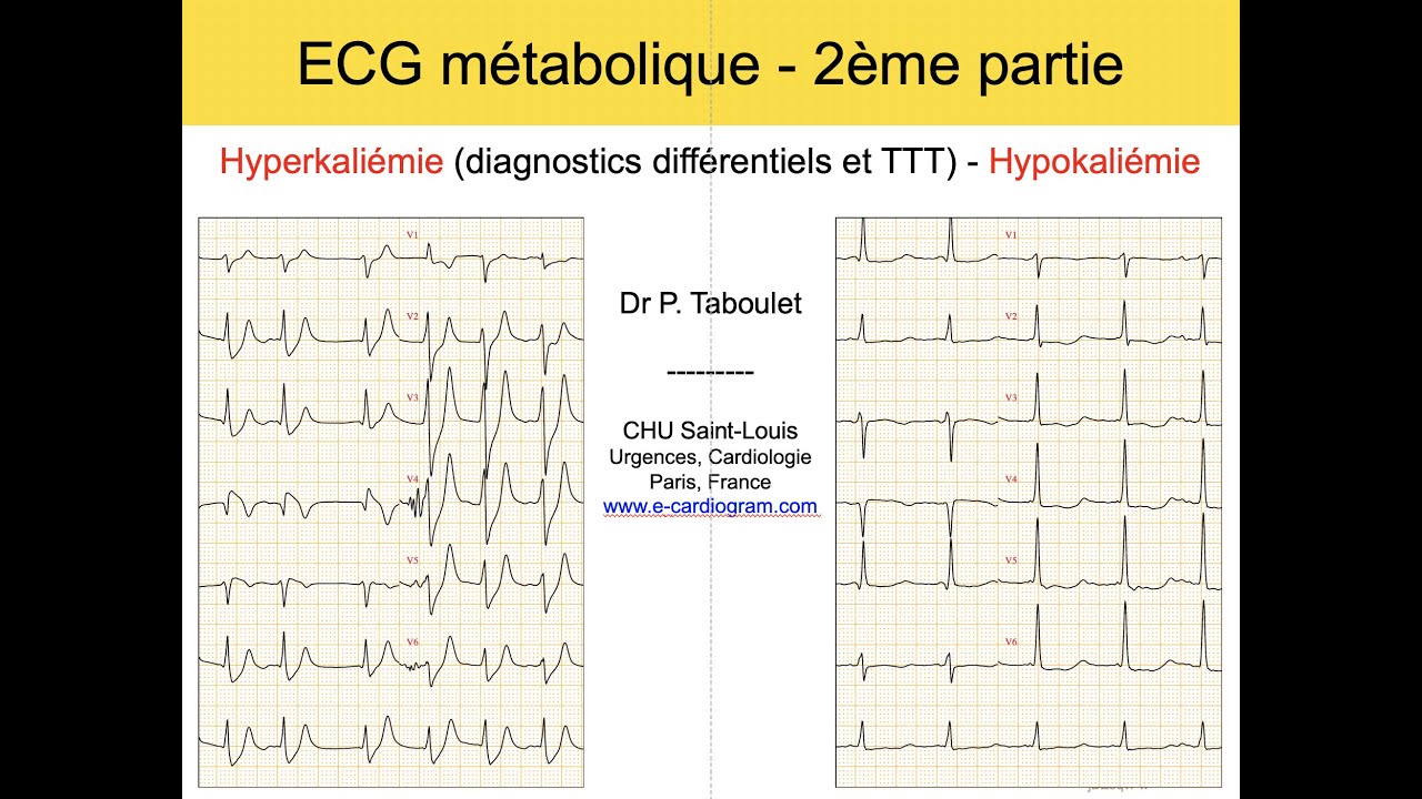 12b. ECG métabolique 2. Hyperkaliémie et Hypokaliémie. - YouTube