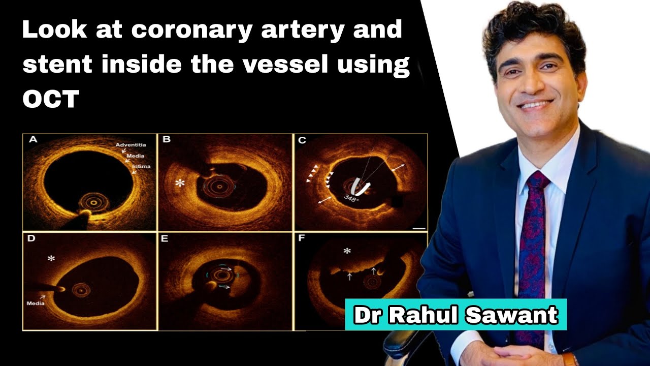 Look at coronary artery and stent inside the vessel using OCT - Dr ...