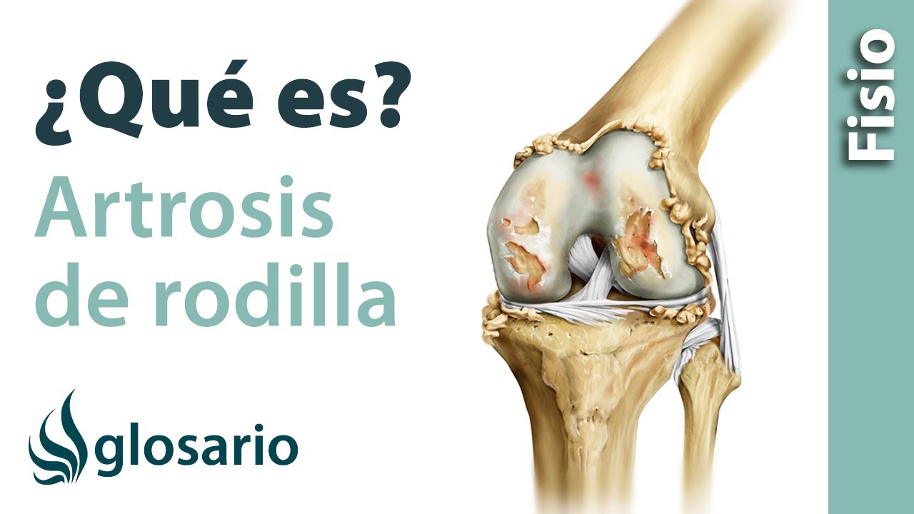 ARTROSIS DE RODILLA | ¿Qué es? - YouTube