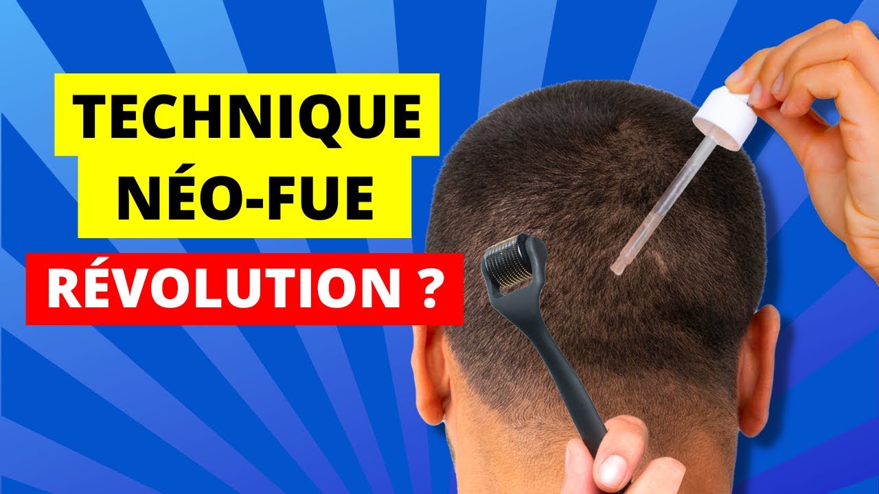 Greffe Neo FUE : Fait-elle repousser plus de cheveux ? 🤔 - YouTube
