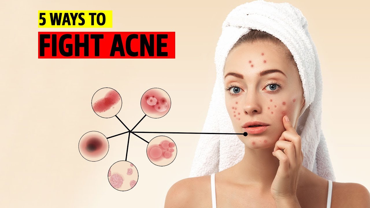 Five ways to Fight ACNE | How to Treat Acne Naturally |How To Prevent ...