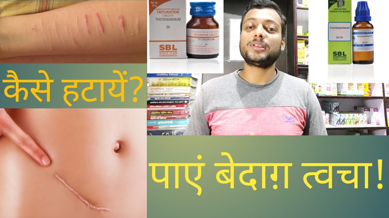 How To Remove Cut Marks scar YouTube how-to-remove-cut-marks-scar-youtube