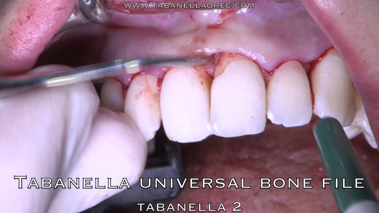 TABELLA UNIVERSAL BONE FILE-TABANELLA 2 - YouTube