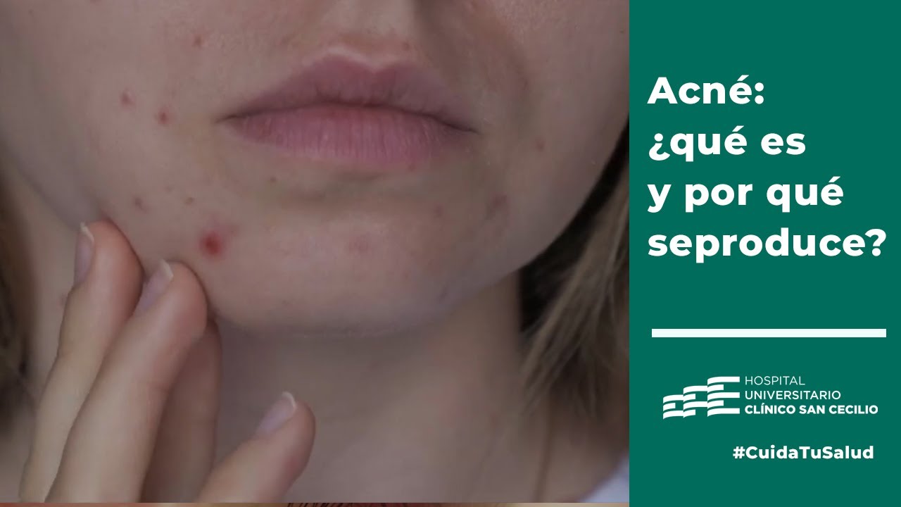 ¿Qué es el acné? ¿Por qué se genera? - #cuidatusalud #dermatologia ...