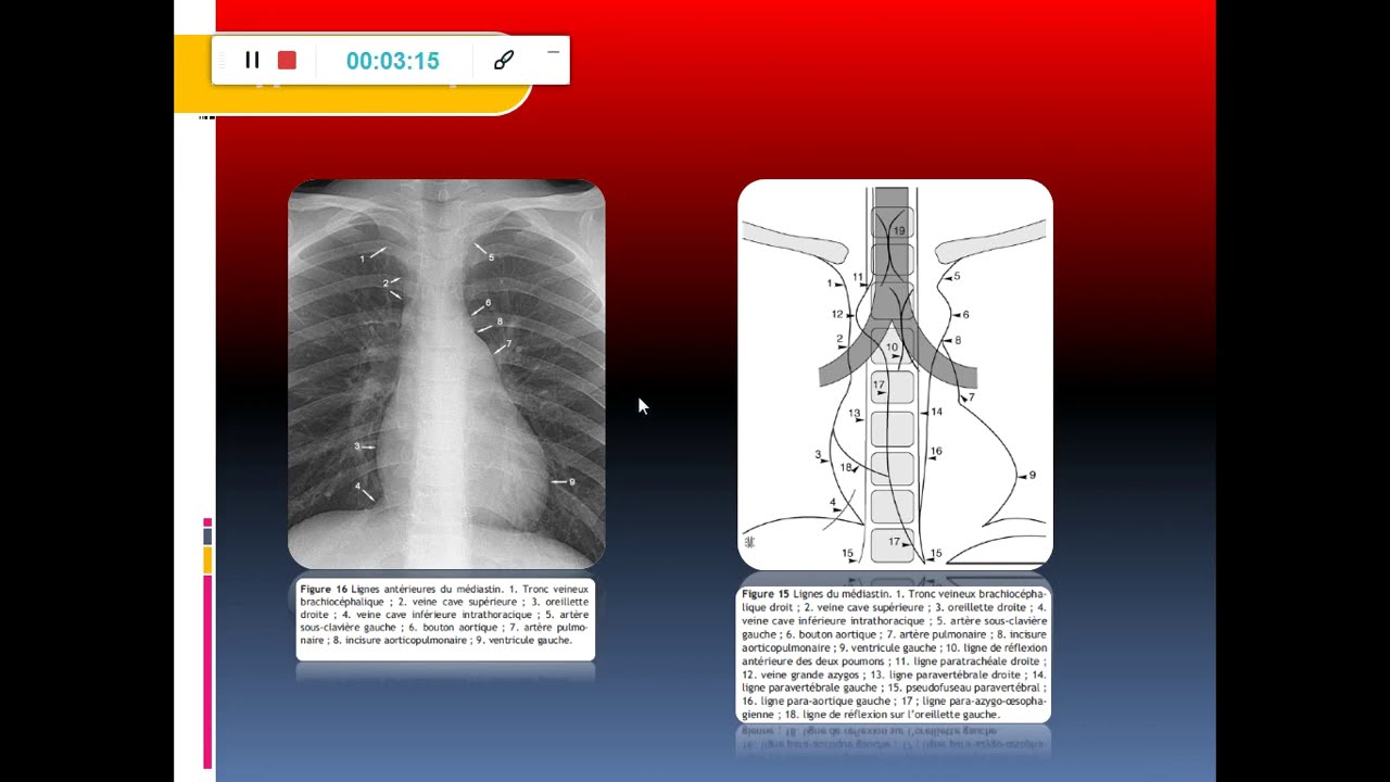 interprétation du télé thorax (TD) Pr Bouabida - YouTube