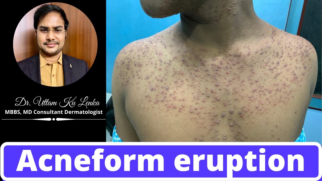 Treatment and reason of Pimples on body/Back(Acneform eruption) Sarir ...