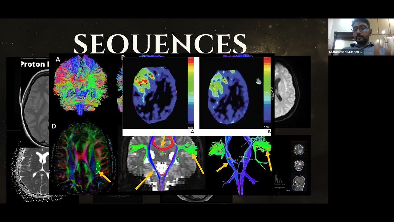 Basics of Brain imaging. CT, MRI, perfusion studies. - YouTube