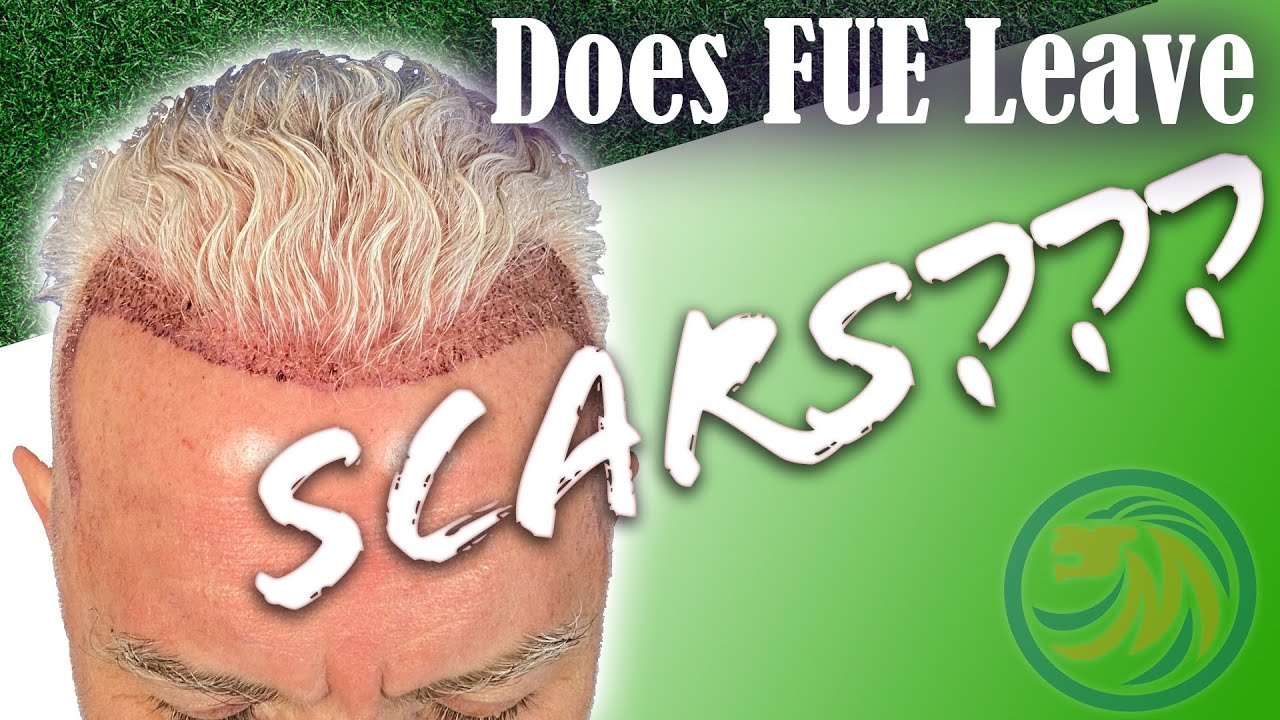 FUE Scars - Hair Transplant Results - YouTube