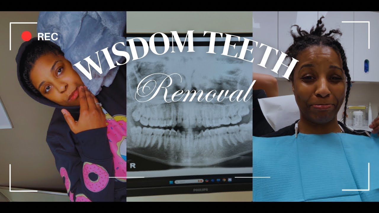 Wisdom Teeth Removal for All 4 Teeth: Process and Recovery - Dr. Had to ...
