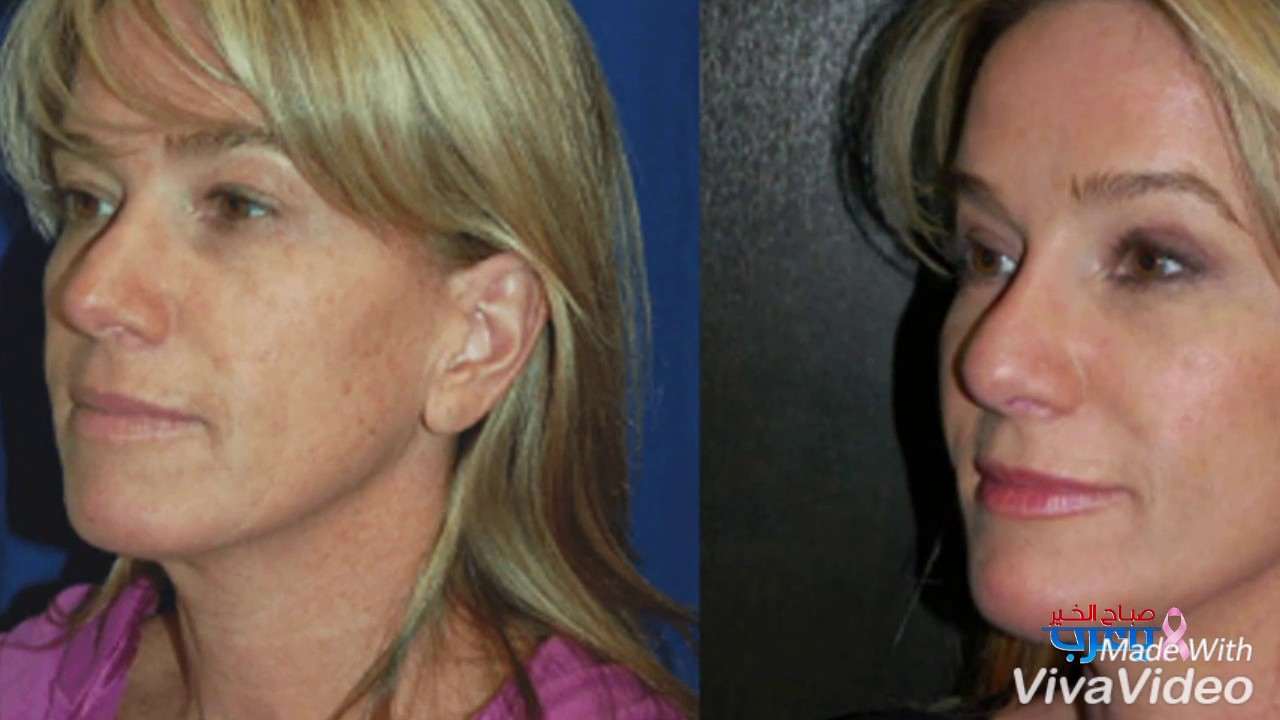 Doctor Jason Diamond Facial Plastic Surgeon & Specialist© - YouTube
