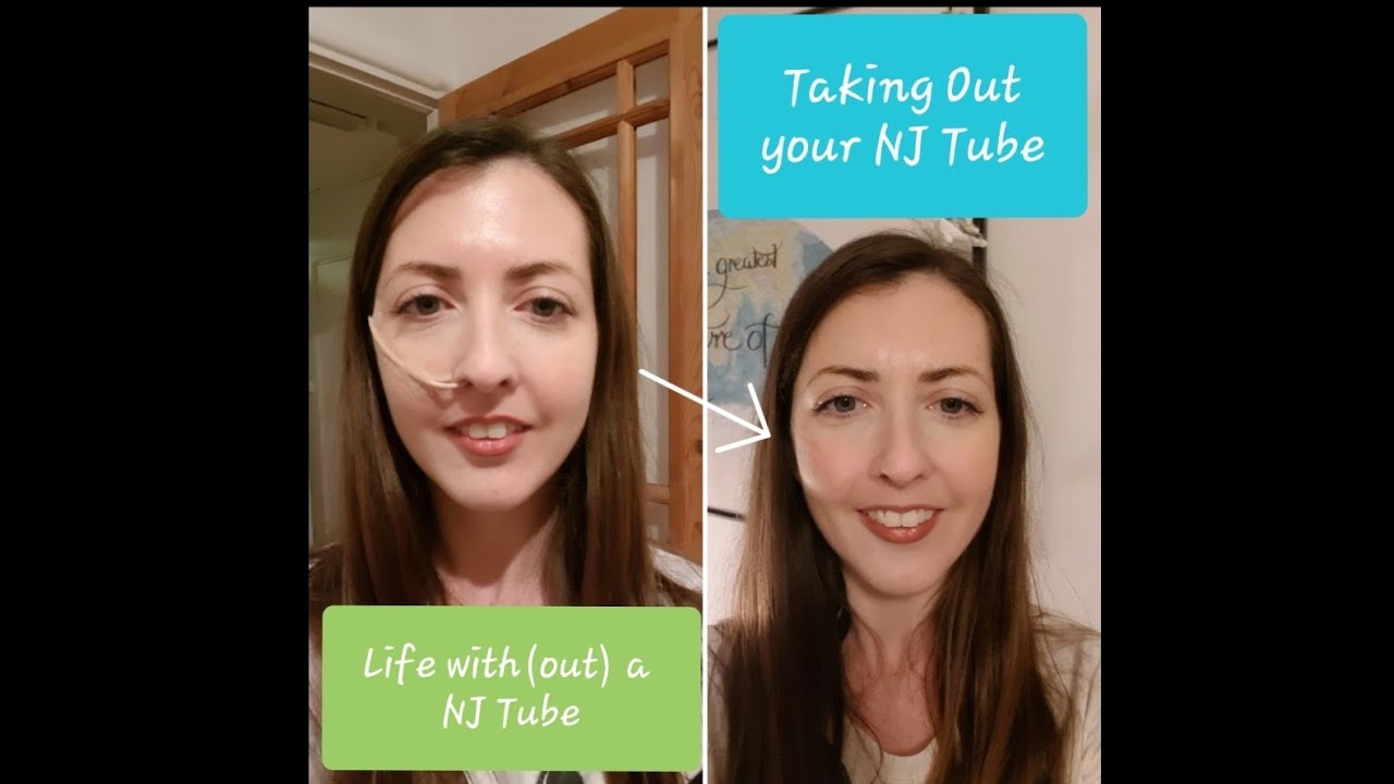 Life With(out) a NJ Tube - Taking Out a NJ Tube - YouTube