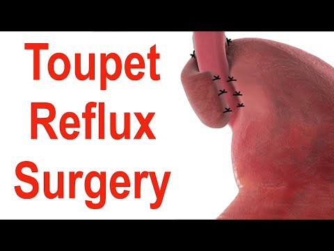 Toupet Fundoplication or 270° Stomach Wrap Surgery to Treat Reflux Animation