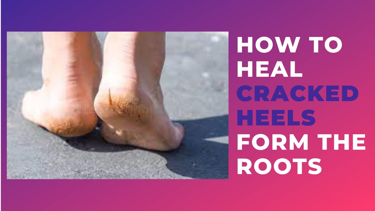 Fati adiya ka gharelu upchar | How to heal Cracked Heels | Fati ediyo ...