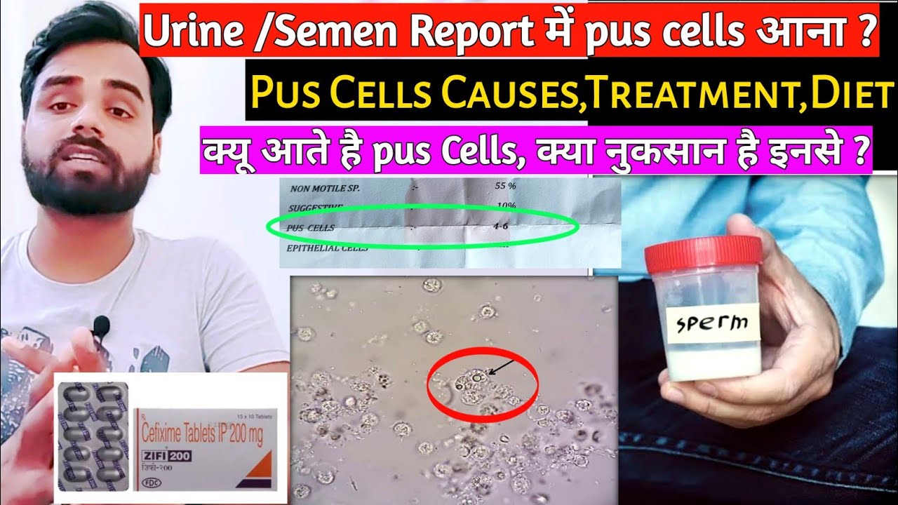 Pus Cells Treatment Urine Semen Pus Cells pus-cells-treatment-urine-semen-pus-cells