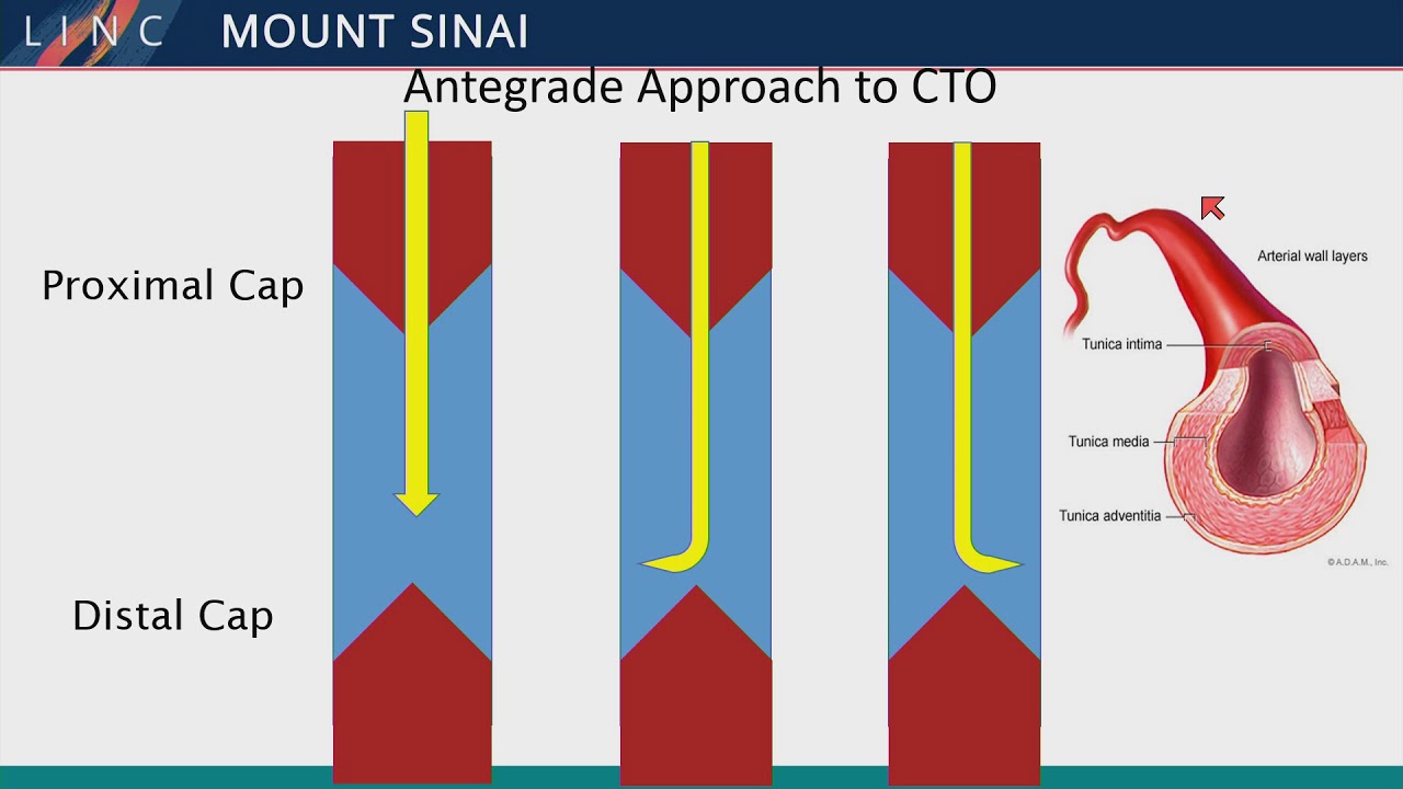 Crossing and Reentry Device Use: Preference vs. Rationale - YouTube