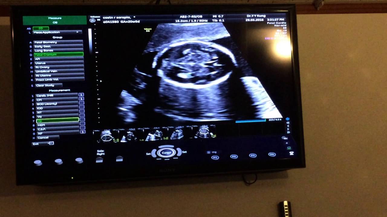 20 weeks Morphology ultrasound scan in Hong Kong | 20 Weeks ultrasound ...