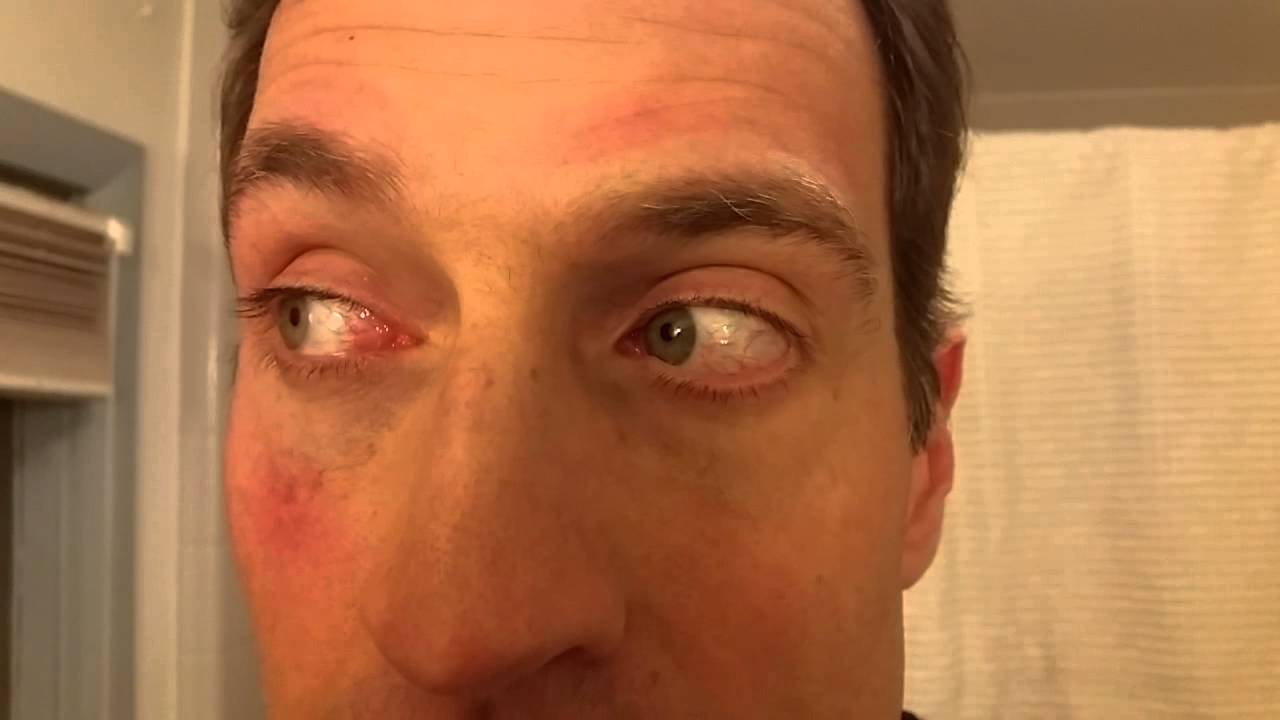 internuclear ophthalmoplegia - YouTube