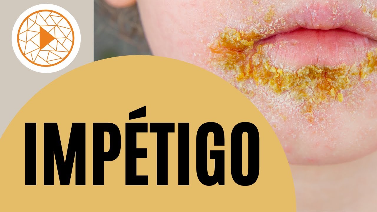 IMPETIGO | ¿Qué es? Descubre los síntomas y su prevención - YouTube