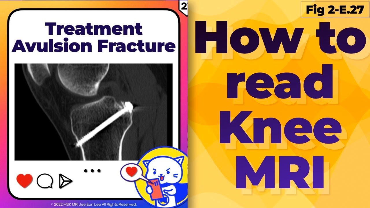 (Fig 2-E.27) Treatment of Acute Avulsion Fracture of PCL - YouTube