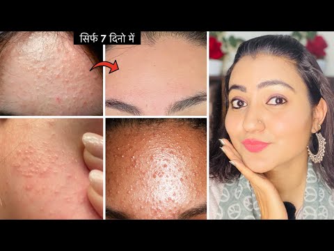 मुश्किल से मुश्किल *Tiny Bumps White Bumps* सफ़ेद दाने Uneven Skintone, Dark Spots का 100% इलाज़ 💕