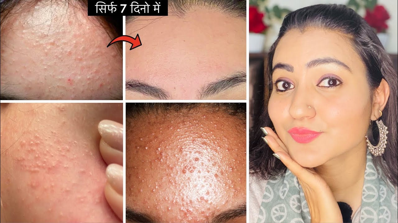 मुश्किल से मुश्किल *Tiny Bumps White Bumps* सफ़ेद दाने Uneven Skintone ...